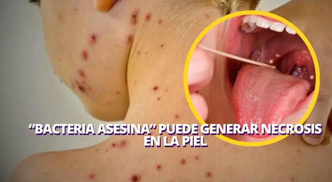 La ‘bacteria asesina’ que alertó a Chile y Japón ya está en Perú ...